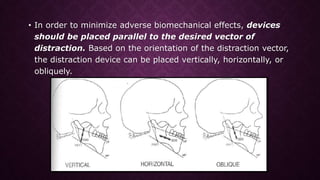 Distraction osteogenesis in maxillofacial surgery | PPTX