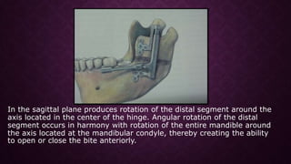Distraction osteogenesis in maxillofacial surgery | PPTX