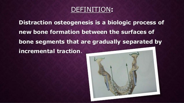 Osteogenesis Distraction Procedure For Adults - scubadedal