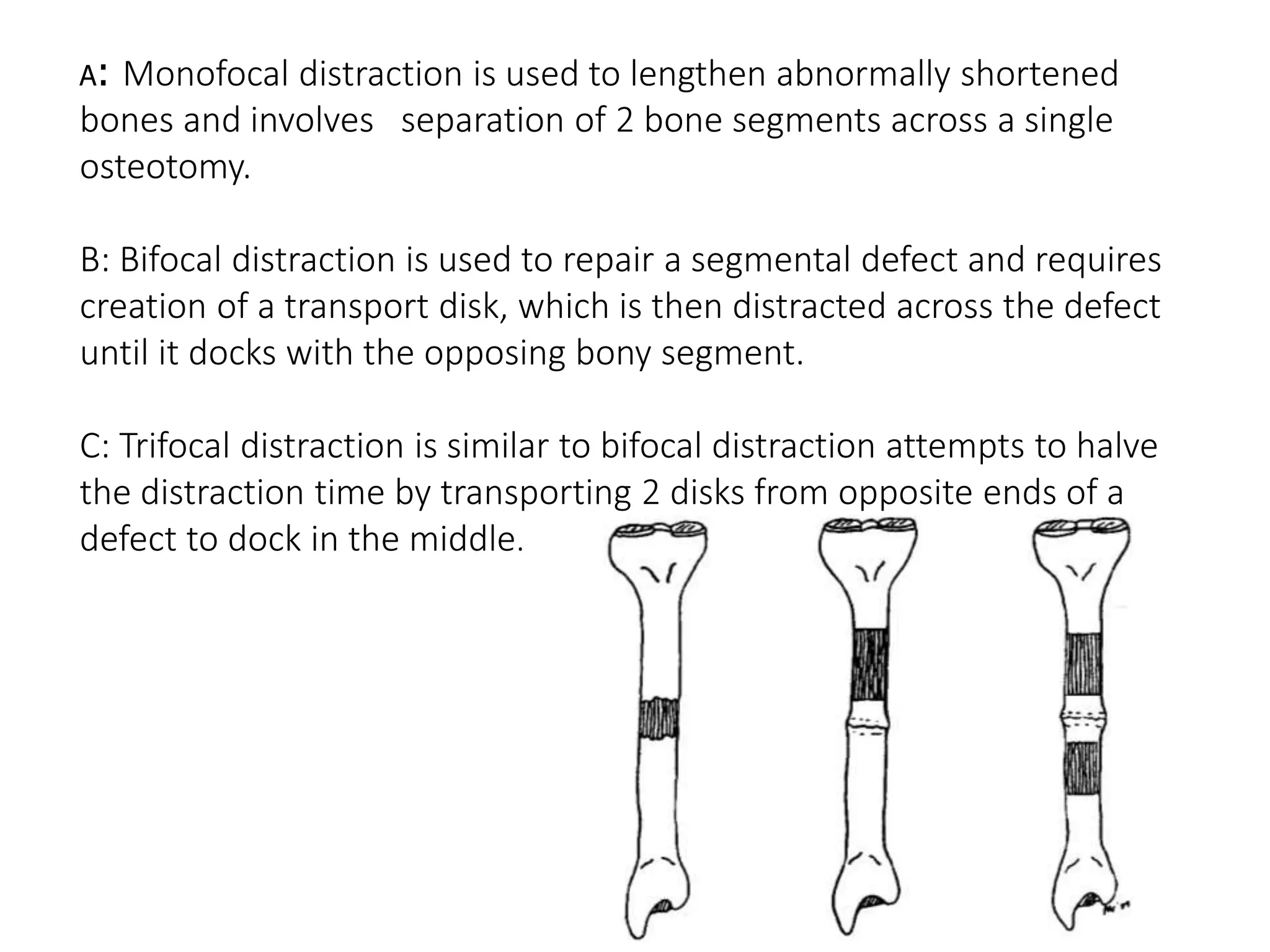 Distraction Osteogenesis of Facial bones | PPT