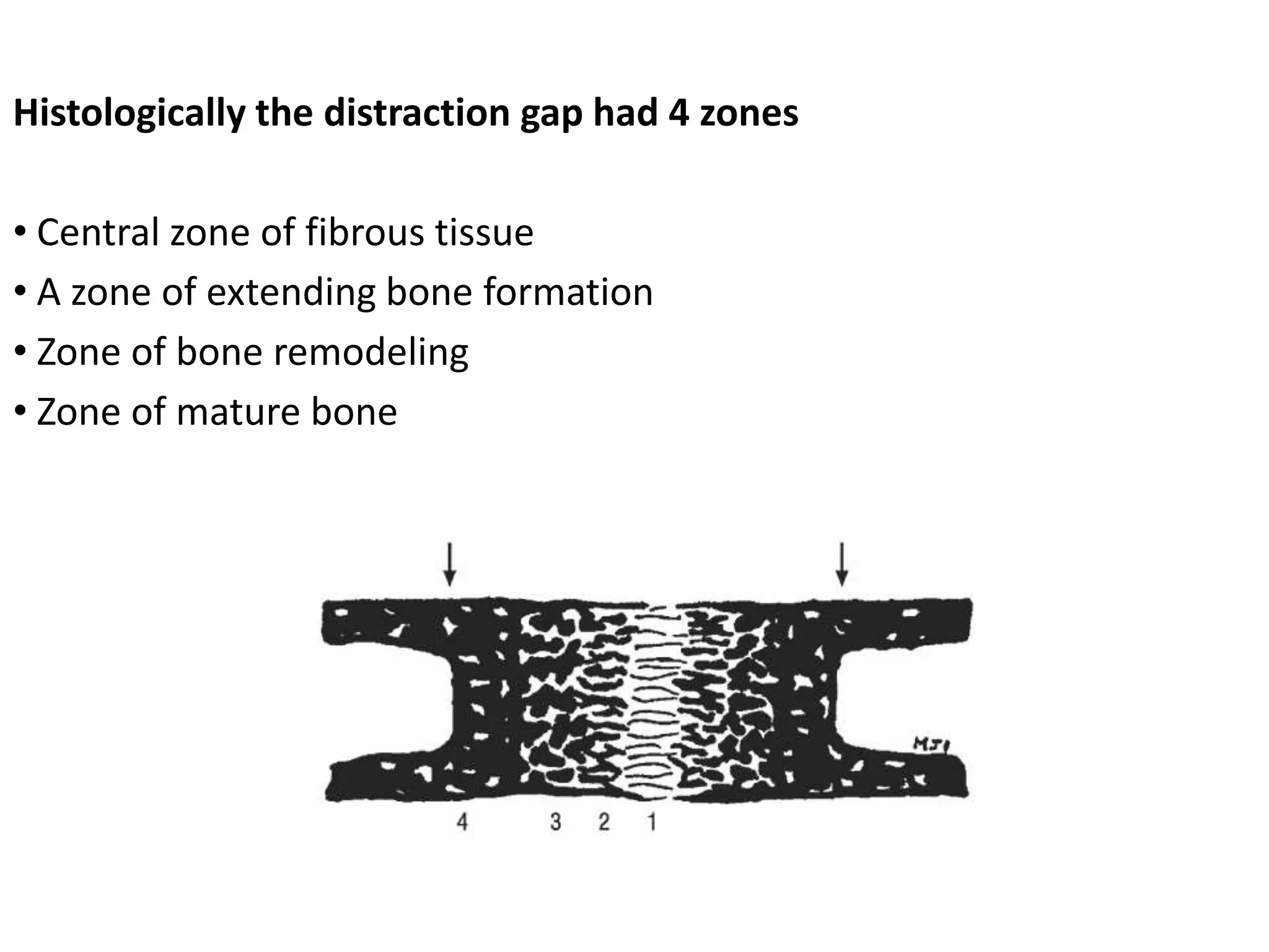 Distraction Osteogenesis of Facial bones | PPT