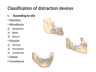Distraction Osteogenesis of Facial bones | PPT