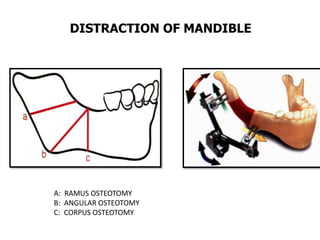 Distraction Osteogenesis of Facial bones | PPT