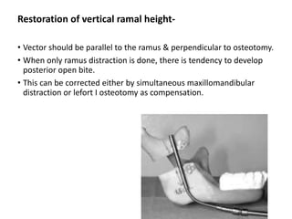 Distraction Osteogenesis of Facial bones | PPT