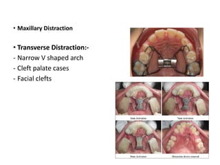 Distraction Osteogenesis of Facial bones | PPT