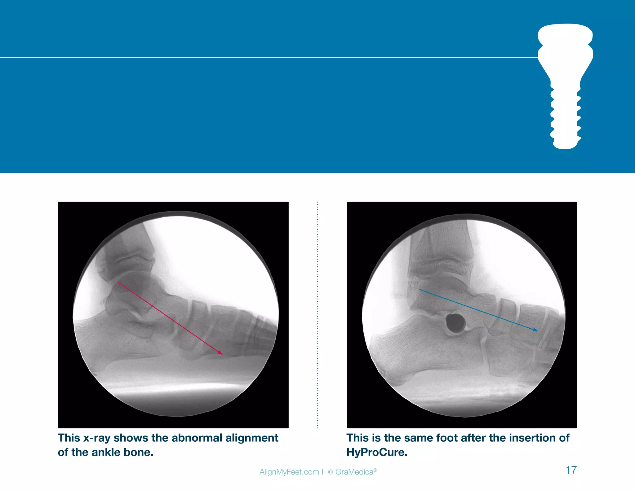 Myths and Misconceptions of HyProCure | PDF