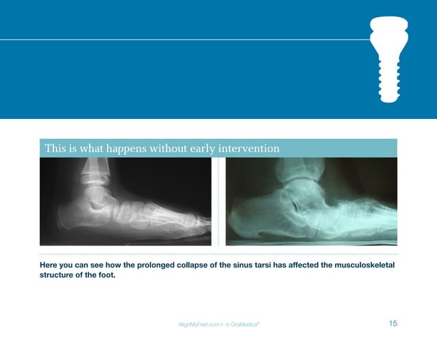 Myths and Misconceptions of HyProCure | PPT