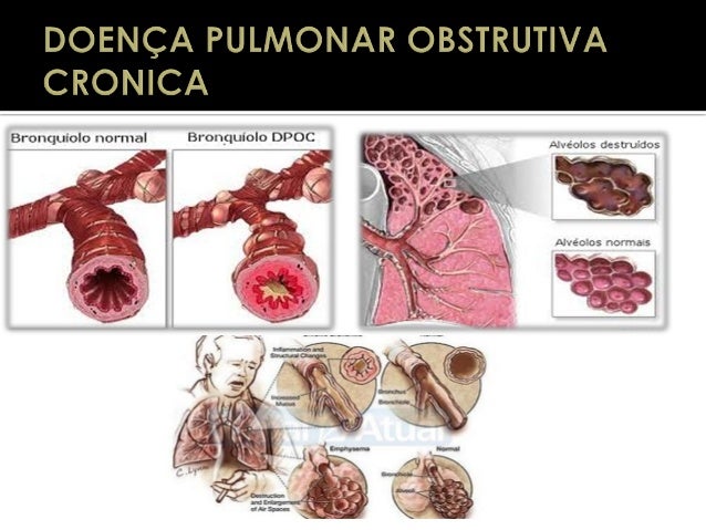 DPOC