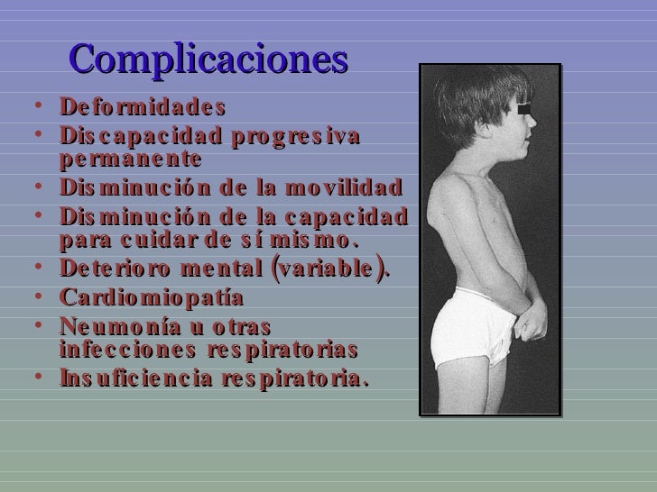 Distrofia Muscular Distal