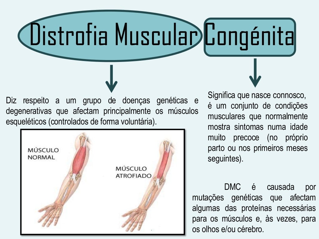 Distrofia muscular congénita