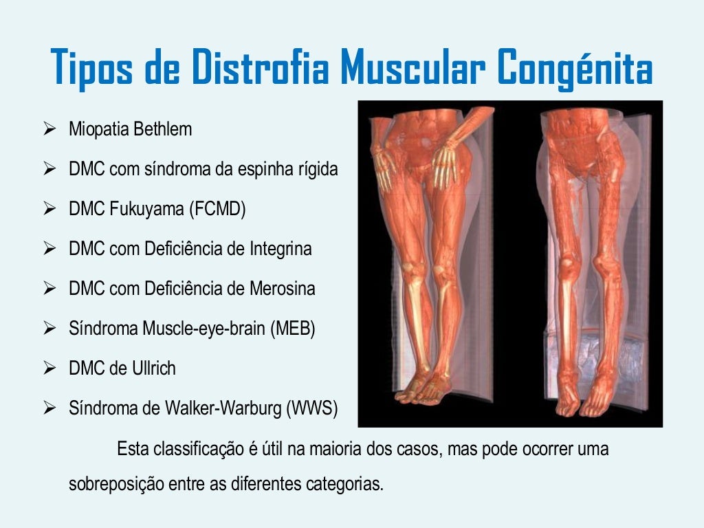 Distrofia muscular congénita