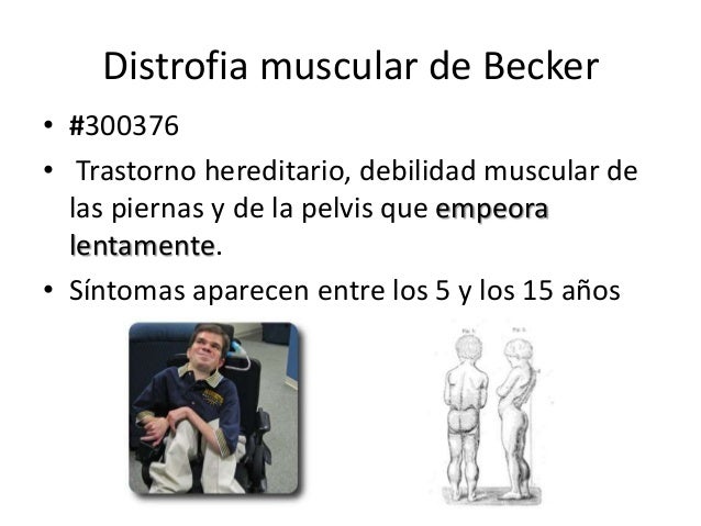 Distrofia muscular de duchenne y becker