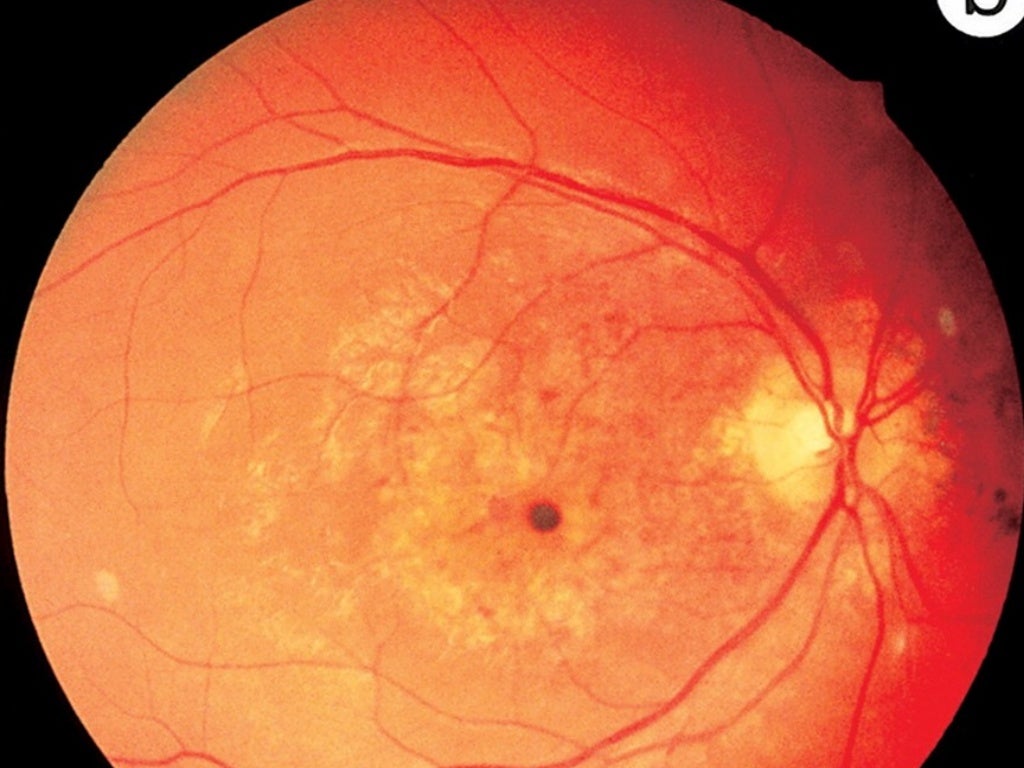 congenital retinal dystrophies