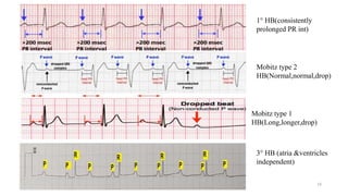 Disturbance of heart rhythm | PPTX