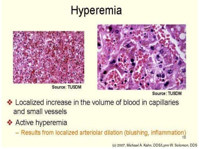 Disturbances of Circulation (Pathology)
