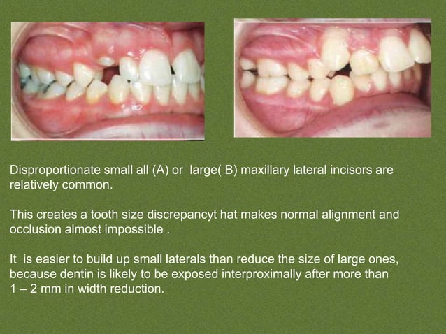 Disturbances of dental development | PPTX