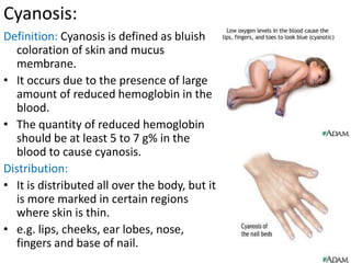Disturbances of respiration 2 | PPTX