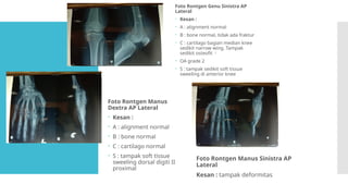 Gout ArthtritisGout ArthtritisGout Artht | PPT