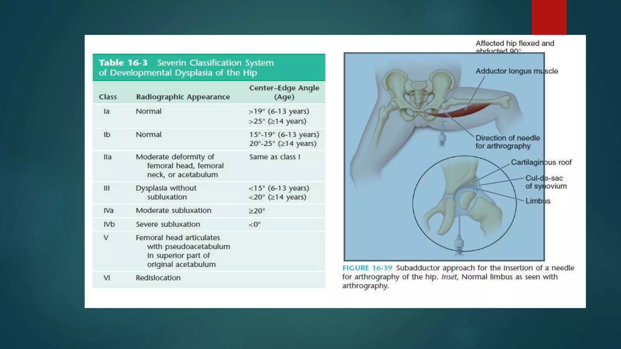 Developmental Dysplasia of Hip | PPTX | Death, Injury, or Military ...