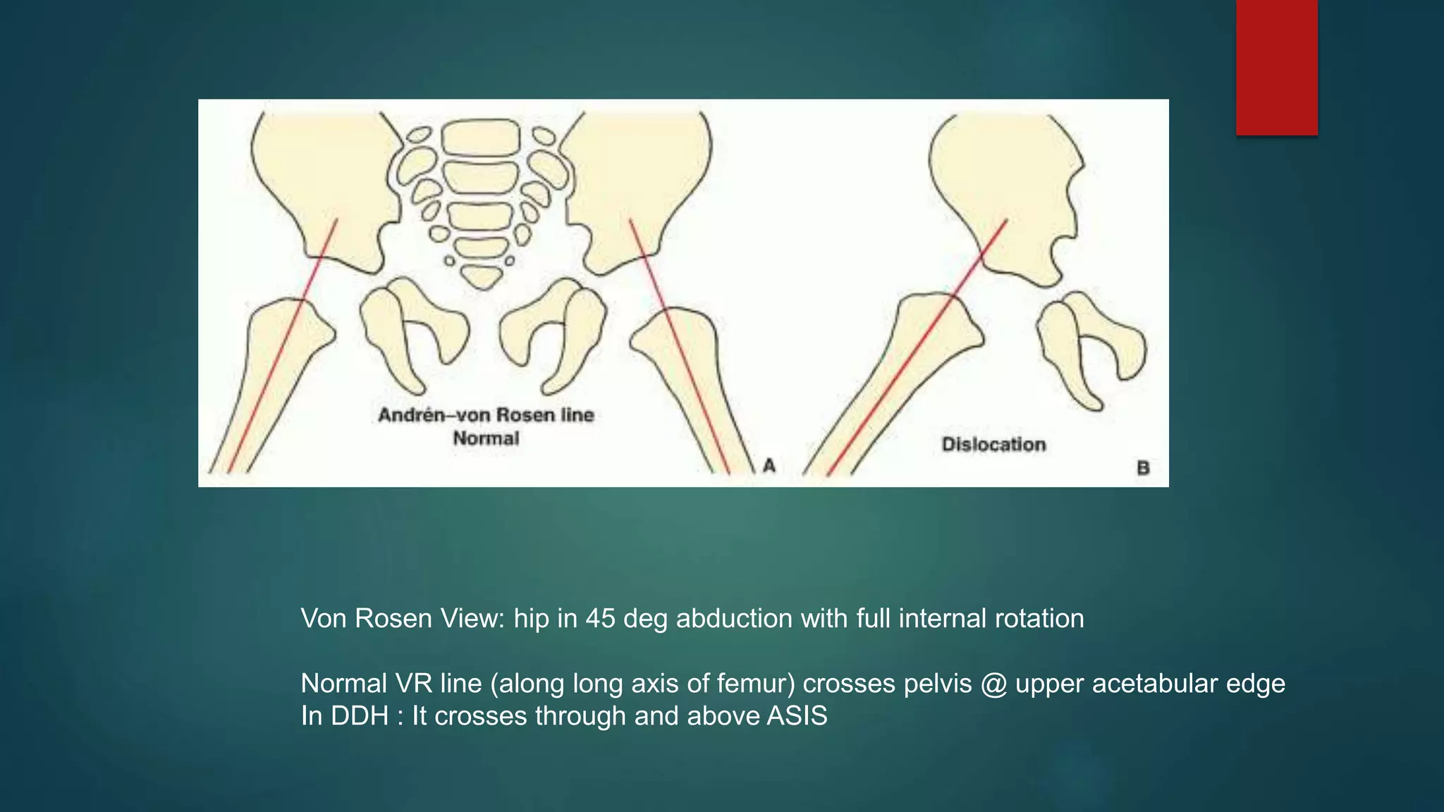 Developmental Dysplasia of Hip | PPTX | Death, Injury, or Military Conflict | Sensitive Topics