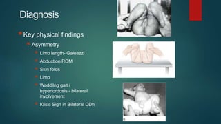 Developmental Dysplasia of Hip | PPTX | Death, Injury, or Military ...