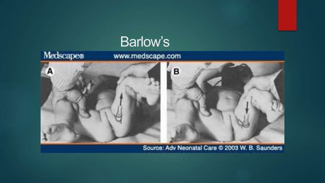 Developmental Dysplasia of Hip | PPTX | Death, Injury, or Military ...