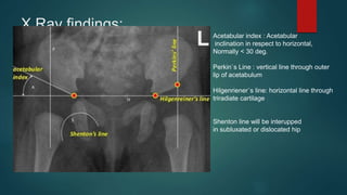 Developmental Dysplasia of Hip | PPTX