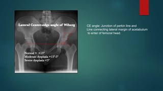 Developmental Dysplasia of Hip | PPTX