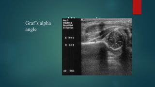 Developmental Dysplasia of Hip | PPTX