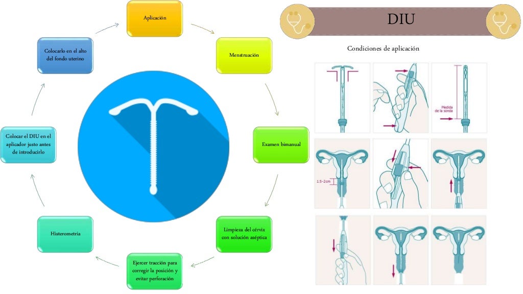 Inserción De Un Dispositivo Intrauterino – BZHV