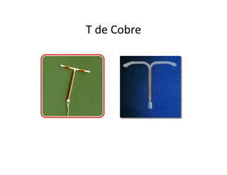 Anticoncepción Intrauterina ( DIU de cobre Vs. DIU hormonal) | PDF