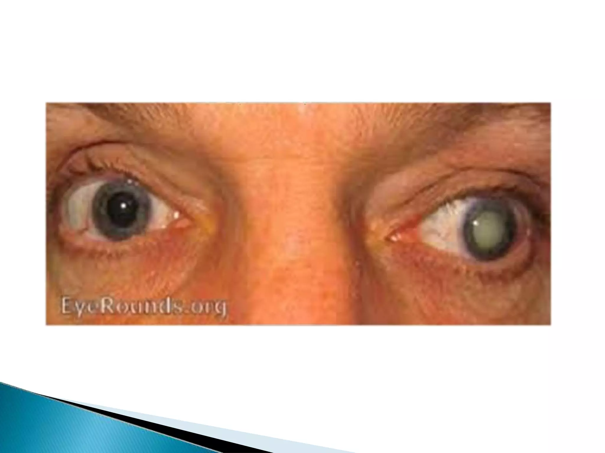 divergent squint.pptx