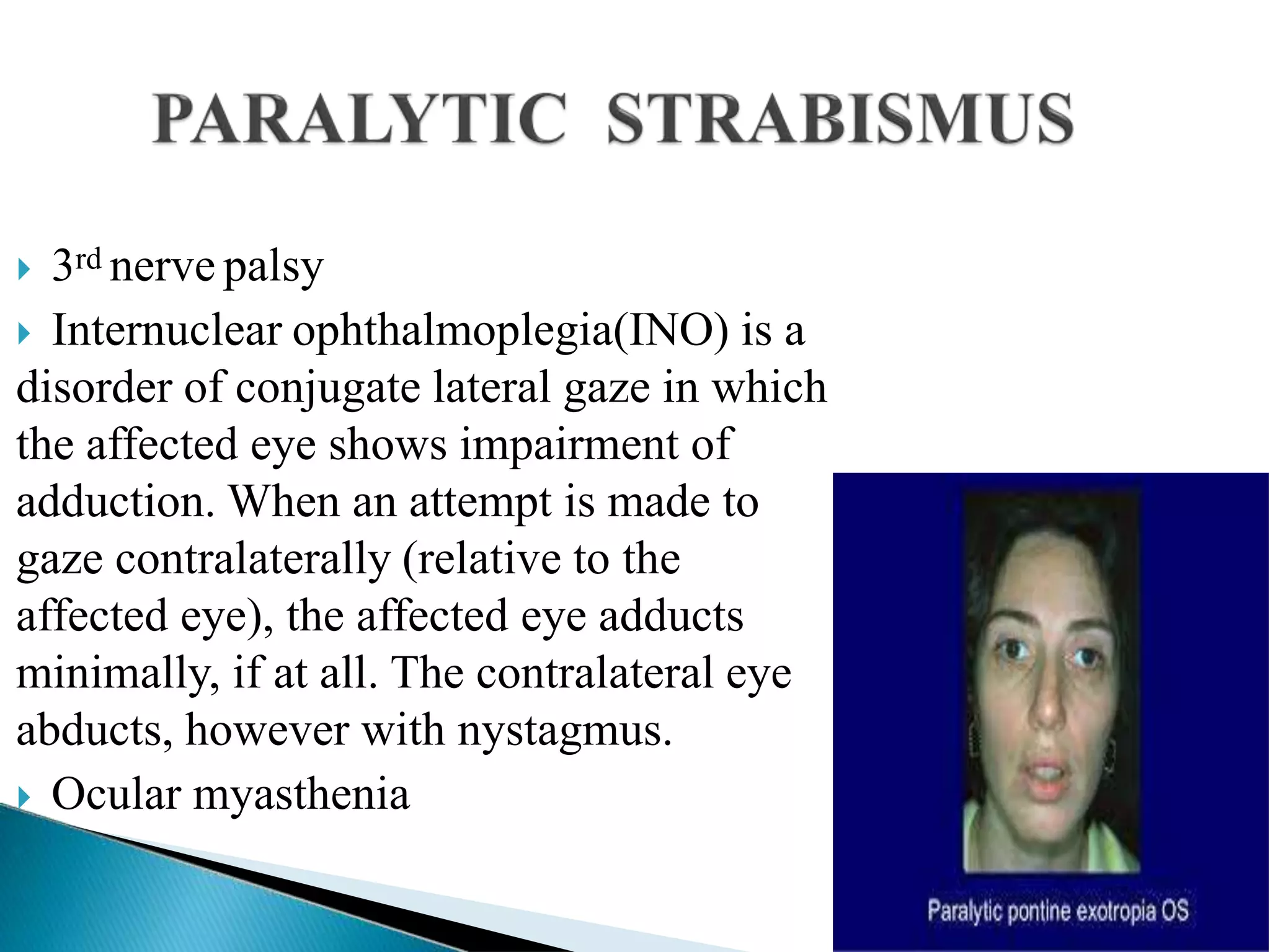 divergent squint.pptx