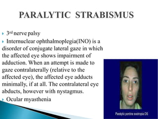 divergent squint.pptx