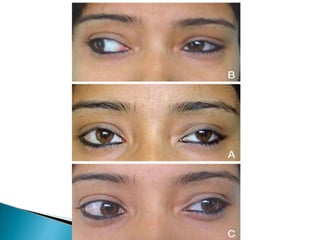 divergent squint.pptx