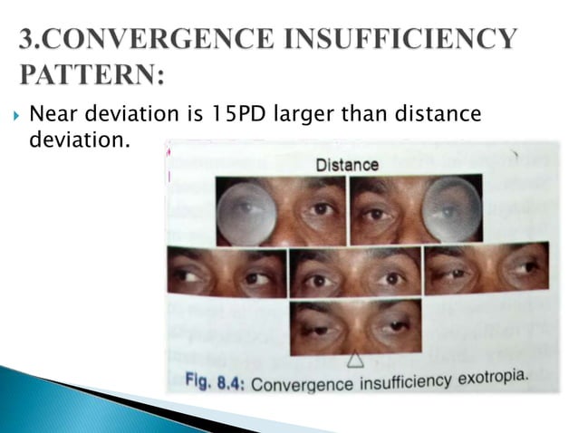 divergent squint.pptx