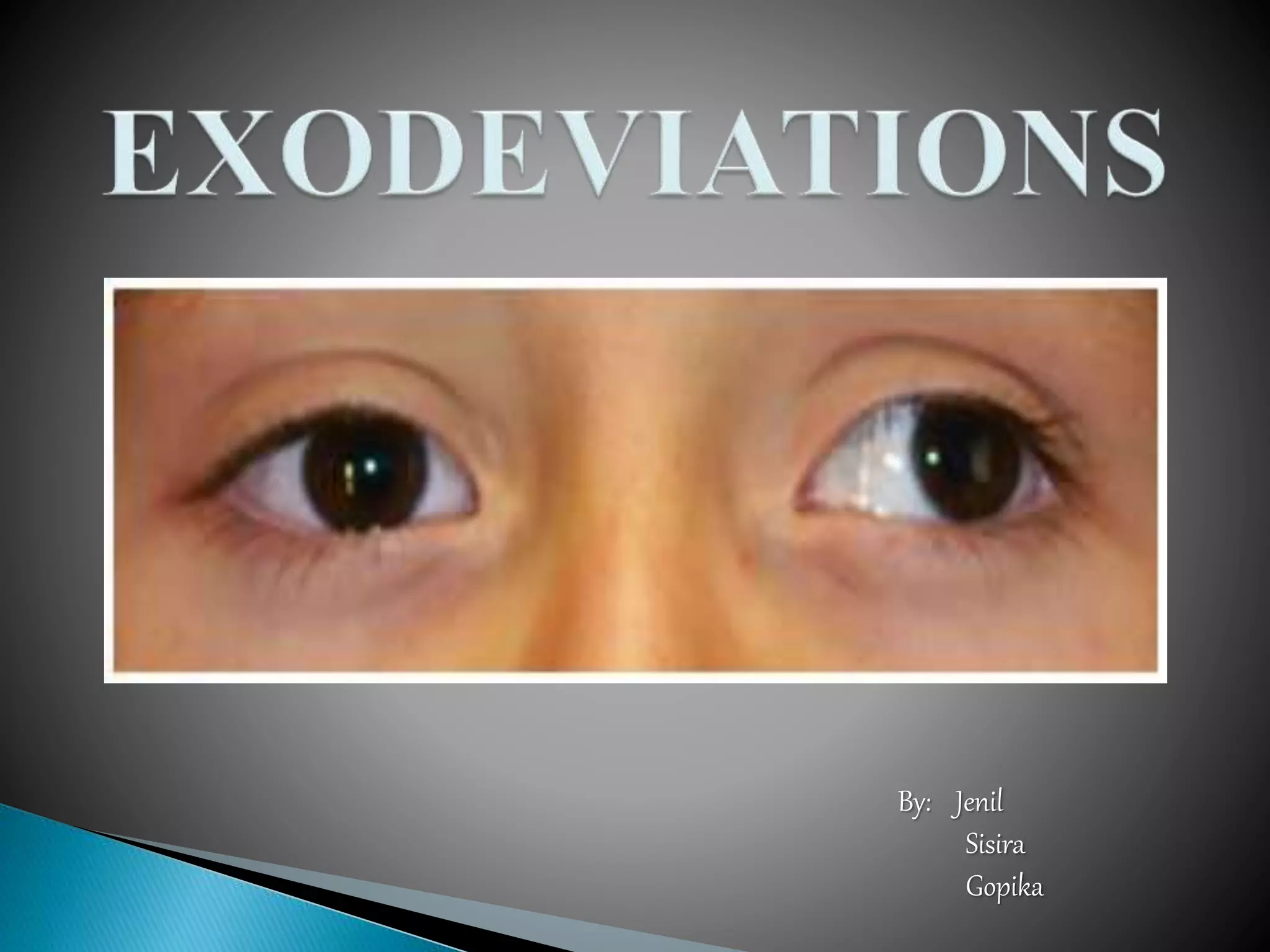 Exodeviations , Exotropia | PPTX