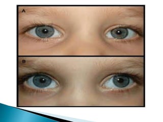 Exodeviations , Exotropia | PPTX