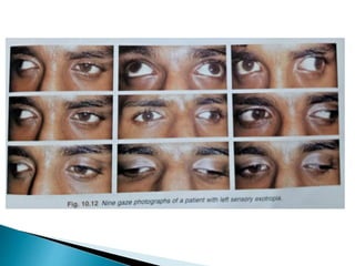 Exodeviations , Exotropia | PPTX