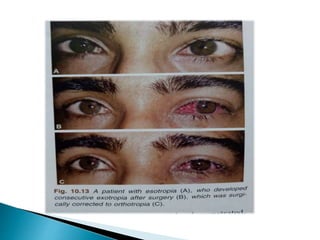 Exodeviations , Exotropia | PPT