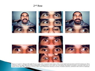 Exodeviations , Exotropia | PPTX