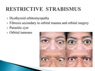 Exodeviations , Exotropia | PPTX