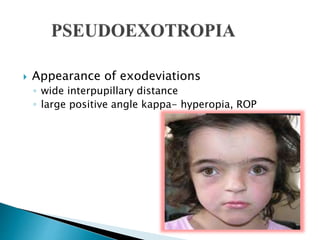 Exodeviations , Exotropia | PPTX