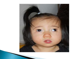 Exodeviations , Exotropia | PPTX