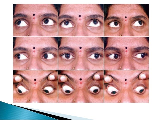 Exodeviations , Exotropia