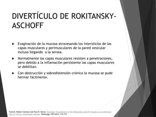 Divertículo de Rokitansky Aschoff | PDF
