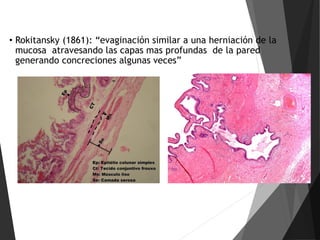 Divertículo de Rokitansky Aschoff | PDF