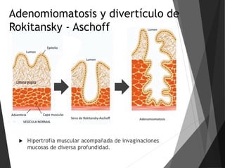 Divertículo de Rokitansky Aschoff | PDF