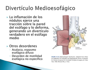 Divertículos esofágicos | PPTX