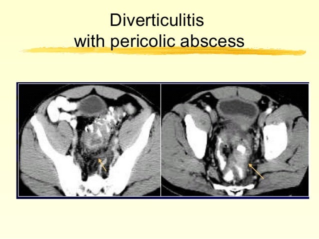 Diverticulitis Abscess
